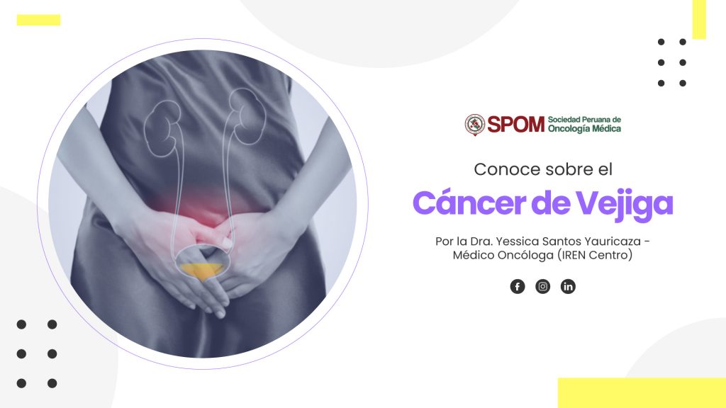 Cáncer de Vejiga - SPOM